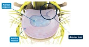 Annular Tear | Sonospine